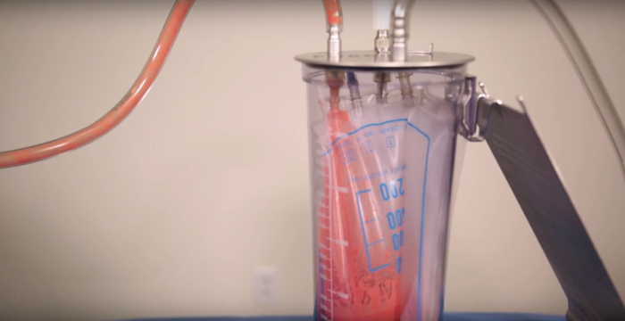 Puregraft Direct Harvest System In-Service Video - Puregraft - The Fat ...